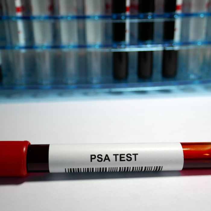 Antígeno Específico de Próstata (PSA) – DEGA Laboratorios